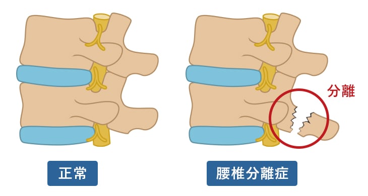 腰椎分離症の主な症状や治療方法について｜西新宿整形外科クリニック 